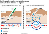 Réaction inflammatoire - DV-FABRIQUE
